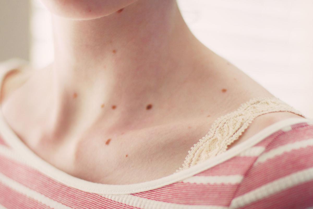 VINAIGRE DE CIDRE contre les VERRUES - Utilisation