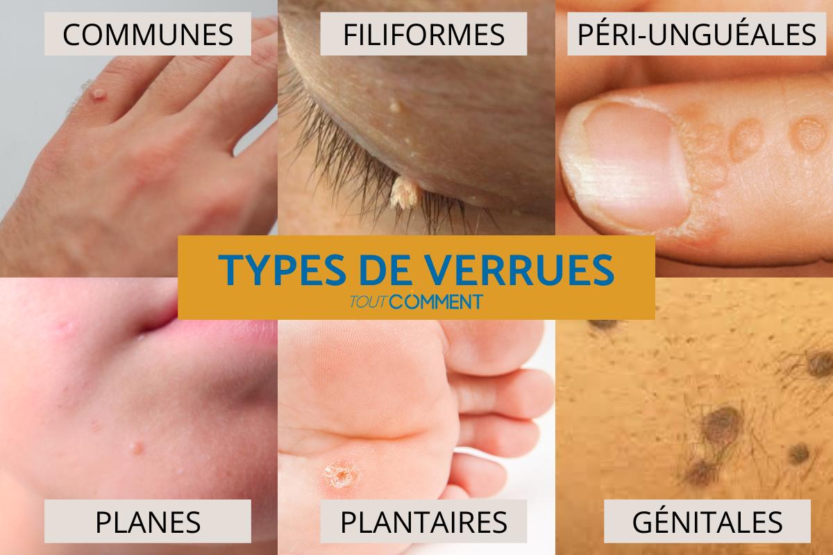 VINAIGRE DE CIDRE contre les VERRUES - Utilisation