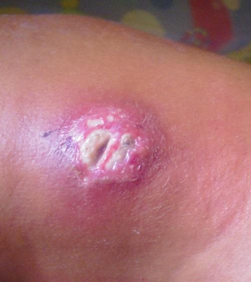 Comment savoir si une brûlure est infectée - 4 étapes