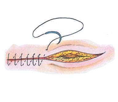 Comment soigner une blessure avec des points de suture