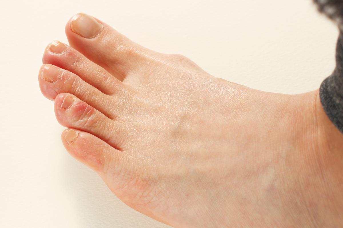 Engelures aux pieds : cause, remède et traitement