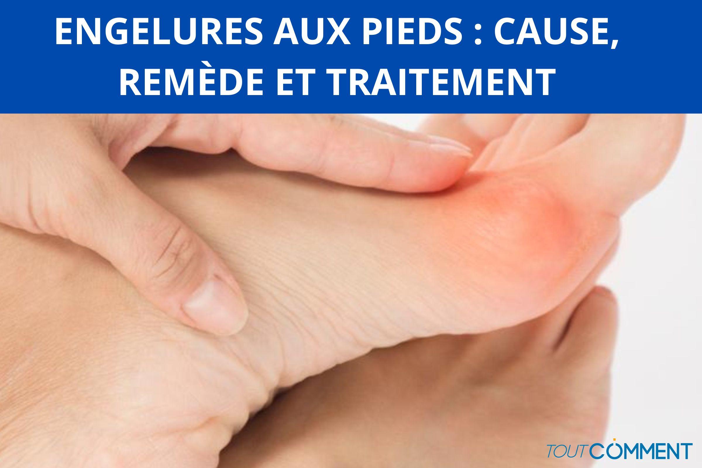 Engelures aux pieds : cause, remède et traitement