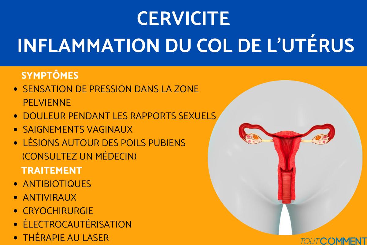CERVICITE - SYMPTÔMES, DIAGNOSTIC et TRAITEMENT