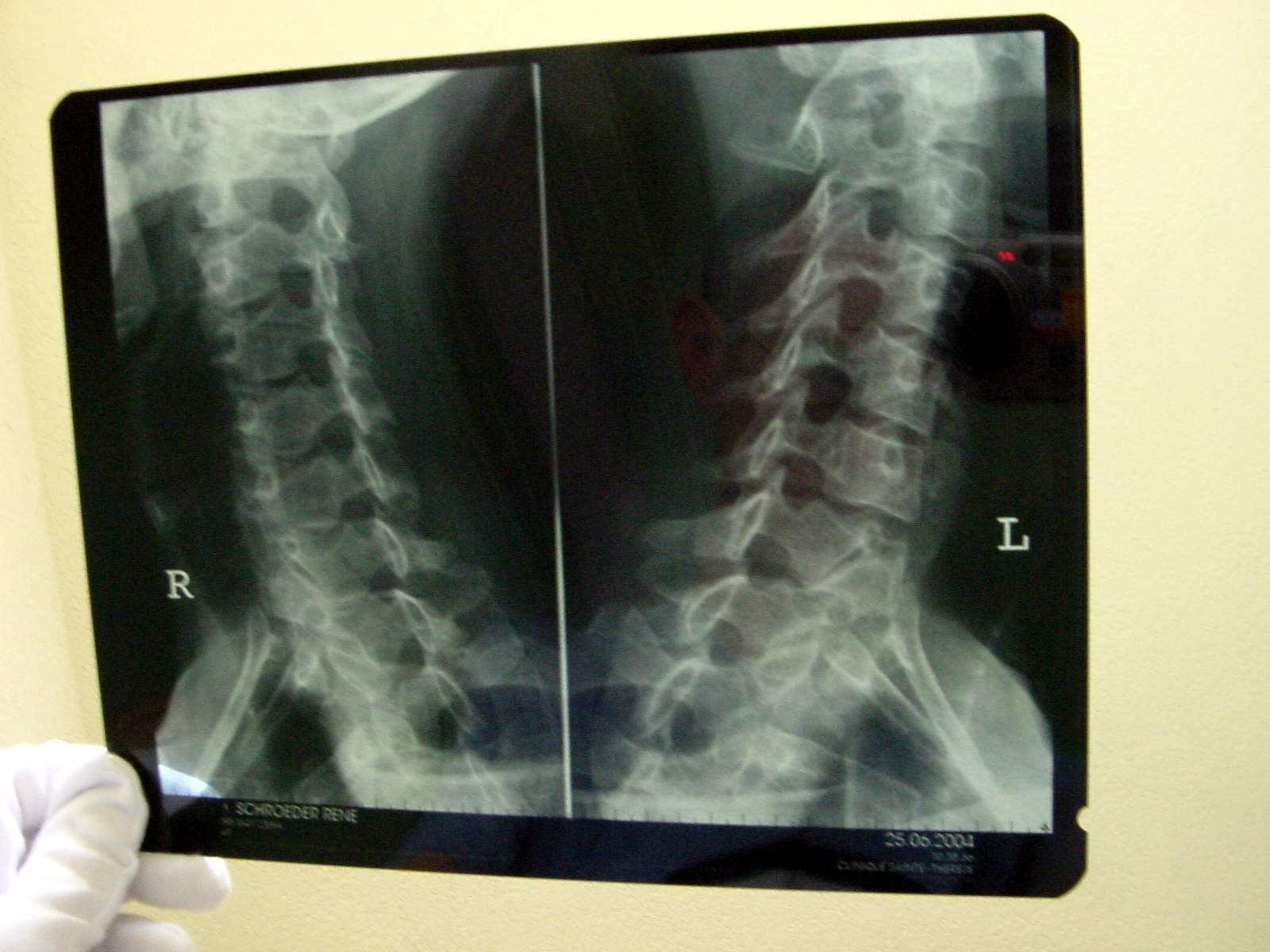 Comment traiter une contracture cervicale - 7 étapes