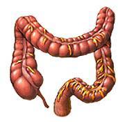 Comment traiter les polypes du côlon - 5 étapes
