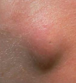 Comment enlever un kyste - 3 étapes