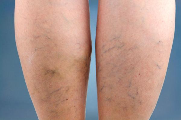 Comment soigner les varices - 6 étapes