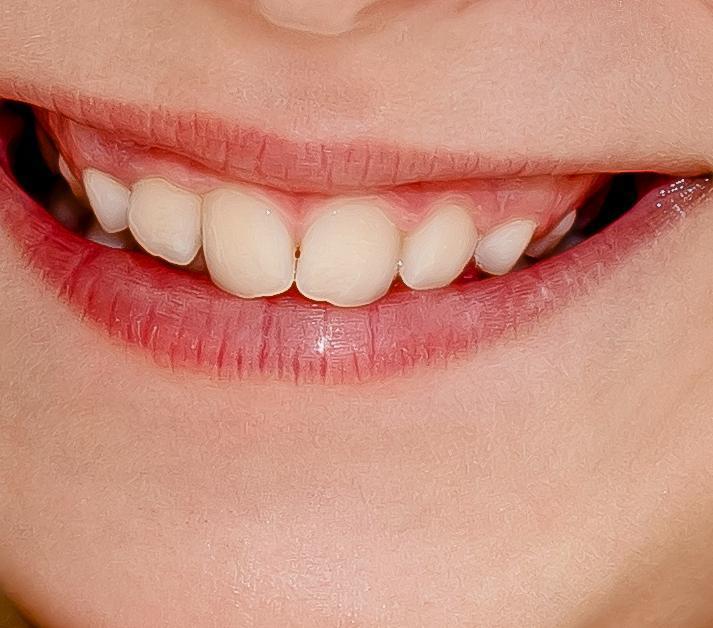 Comment régénérer l'émail des dents - 7 étapes