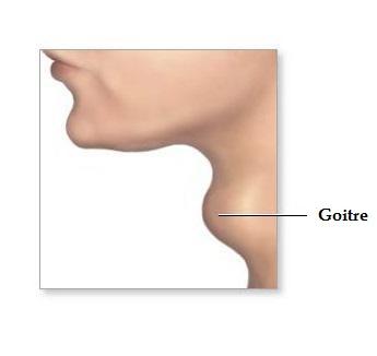 Quels sont les symptômes d'un goitre - 7 étapes