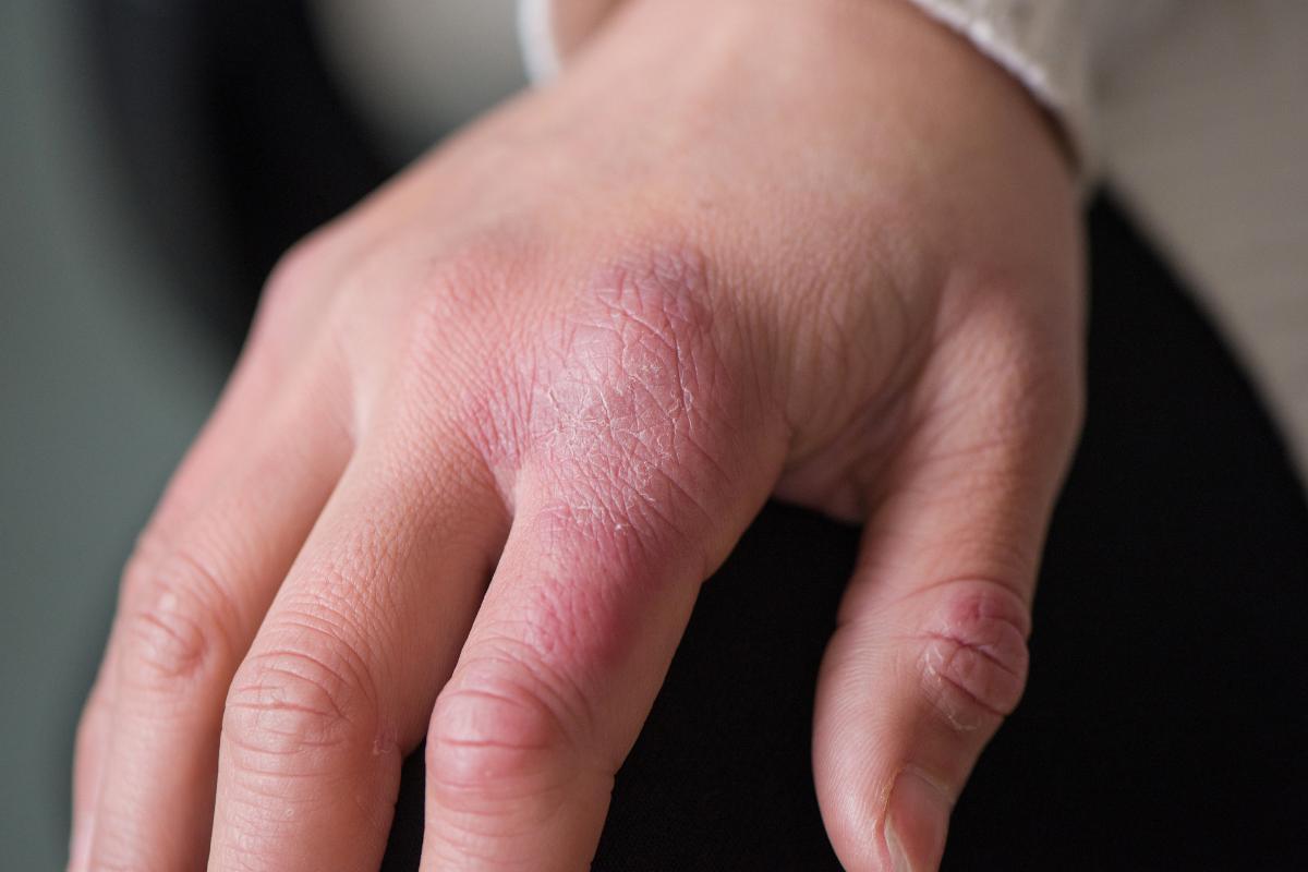 Engelures aux mains : traitement et que faire