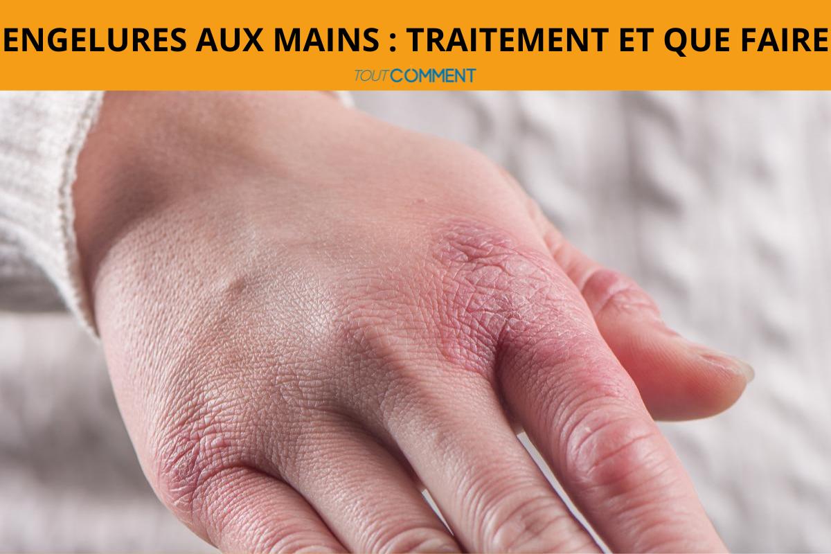 Engelures aux mains : traitement et que faire
