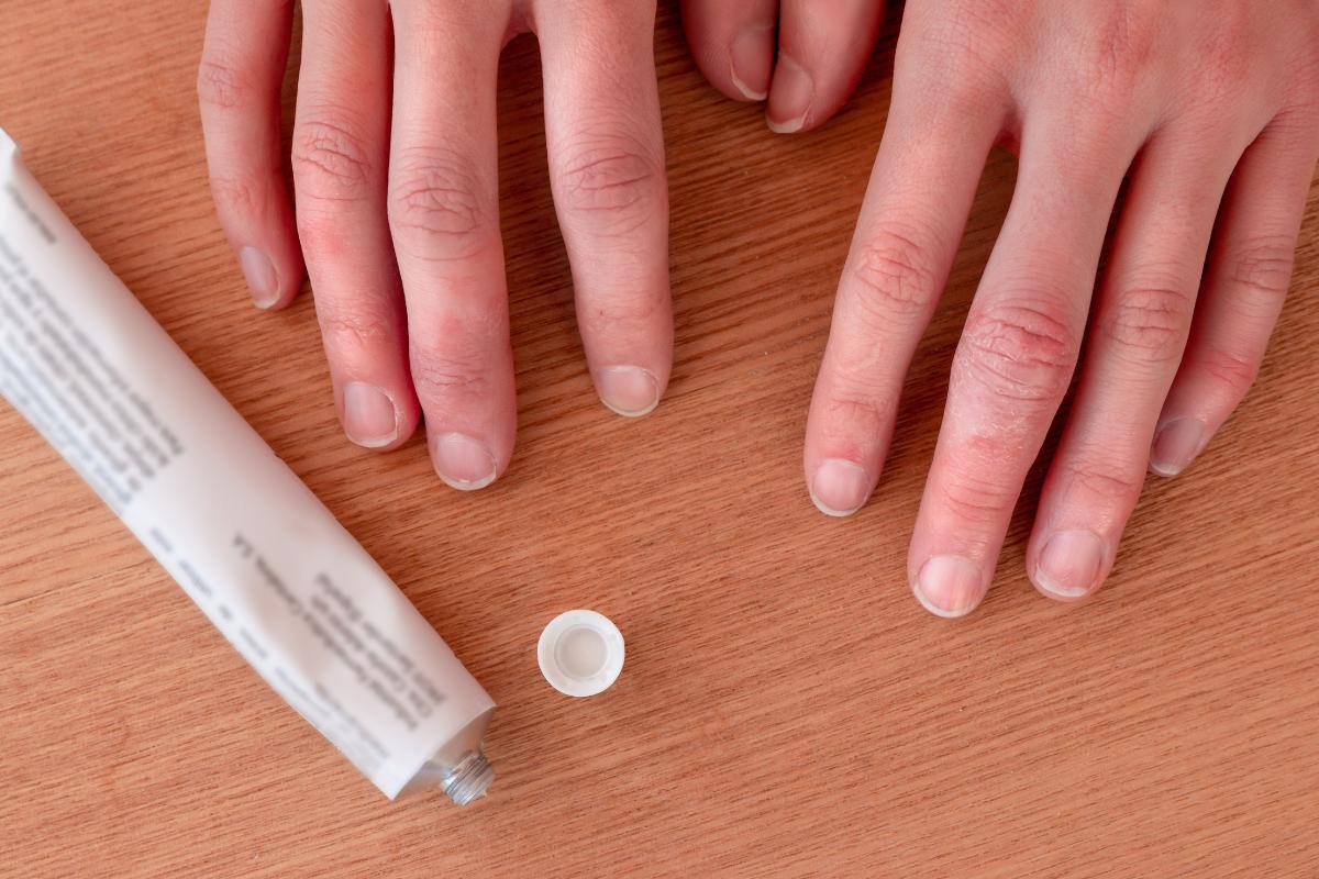 Engelures aux mains : traitement et que faire