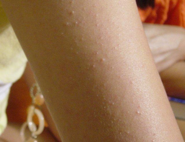 Comment enlever les boutons sur les bras - 8 étapes